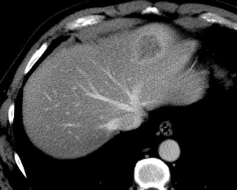 Liver Atlas Case 255 Cholangiocarcinoma