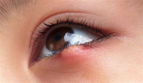 Tic En El Párpado Inferior Tics En Los Ojos Causas Y Tratamiento
