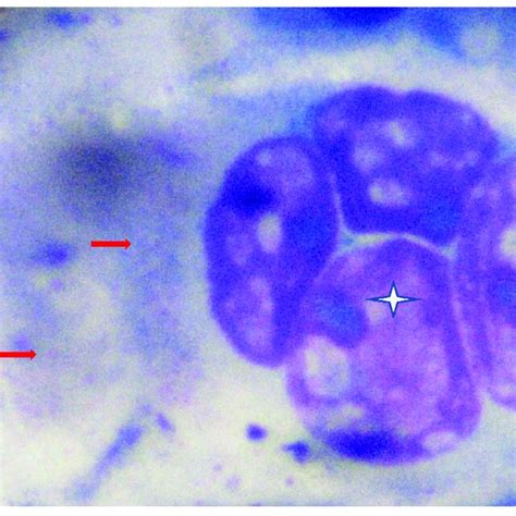 Polynucleation Of The Epithelial Cell Cross And Dust Precipitates