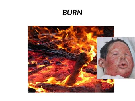 Burn By Kng Kyr 1pptdegrees Of Burningclassification Of Burns Ppt