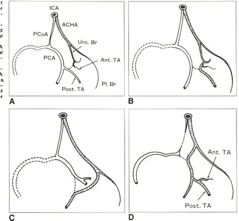 Figure 17 From Anterior Choroidal Artery Angiographic Analysis Of
