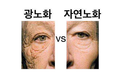 광노화피부 Vs 자연적인 피부노화 네이버 블로그