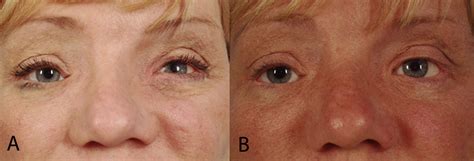 Conjunctival Fat Grafting For Improved Aesthetics Of An Ocular