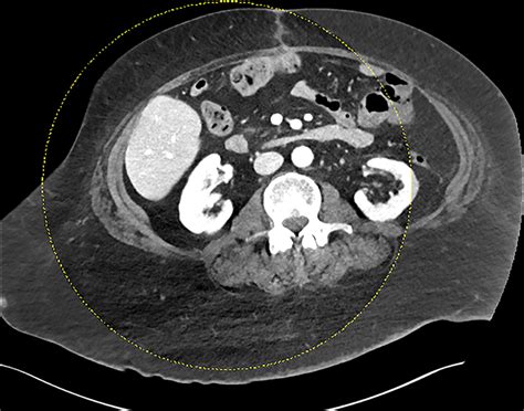 Dual Energy Ct Evaluation Of Gastrointestinal Bleeding Radiographics