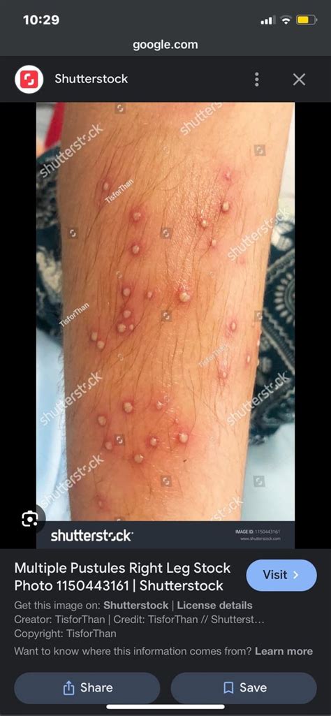 Random Large Pustule On My Leg That Popped The Second I Touched It R