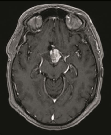 Gadolinium Contrast Enhanced Mri Of The Brain A B First Mri After