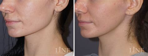 Gallery Jawcheek Shaving Best Plastic Surgeon In La Line Plastic
