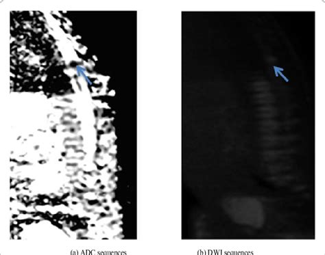 A Adc And B Dwi Sequences Respectively Show Diffusion Restriction