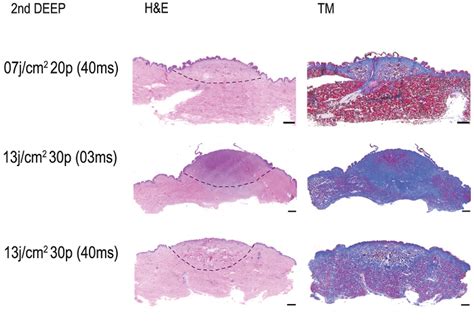 Figure 4 From A New Ex Vivo Human Skin Burn Model Semantic Scholar