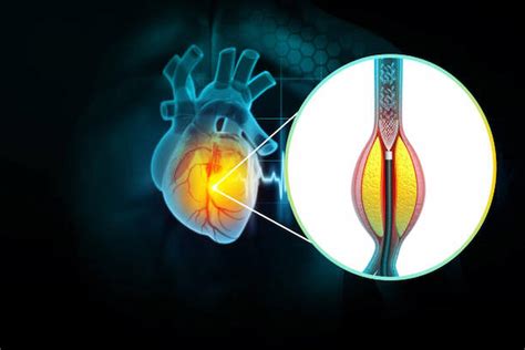 The Causes And Symptoms Of Angina A Type Of Chest Pain