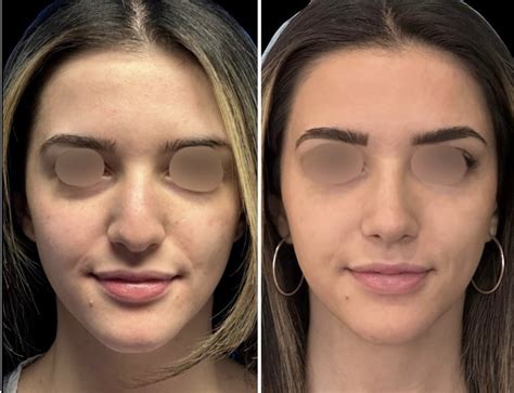 Bulbous Nose Rhinoplasty In Toronto Big Nose To Small Nose Surgery