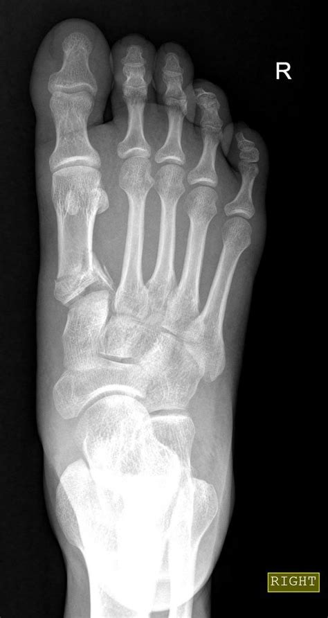 Metatarsal Head Fracture