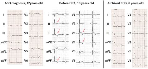 Ecg In Patient 1 T Waves In Leads Iii And V1‐3 Were Negative At
