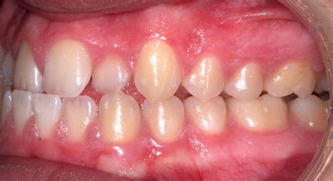 Clear Aligners The Before And After Master Clear Aligner