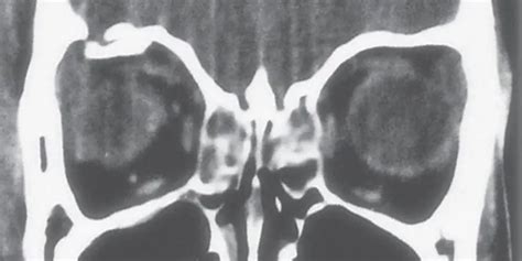 Most Orbital Roof Fractures Can Be Managed Conservatively American