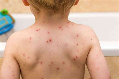 Viruela El Primer Virus En Ser Erradicado Primera Edición
