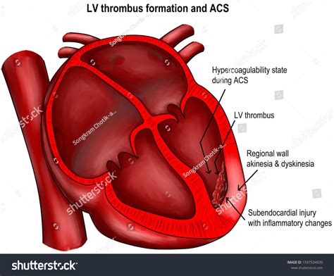 Myocardial Infarction Mural Thrombus Formation Stock Illustration
