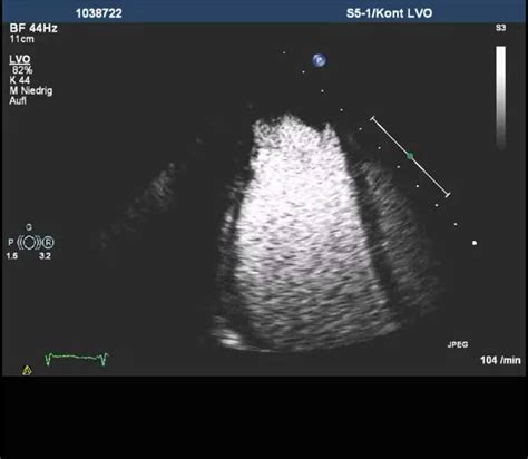 Thrombus Youtube