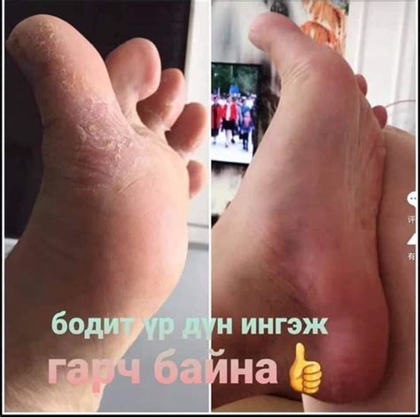 Хөл гарын хумсны мөөгөнцөр арилгагч