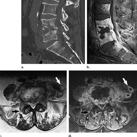Thoracic Tuberculous Spondylodiscitis In A 30 Year Old Man With Mid