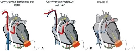 Catheter Based Rv Support With Oxygenator 2 Catheter Technique A