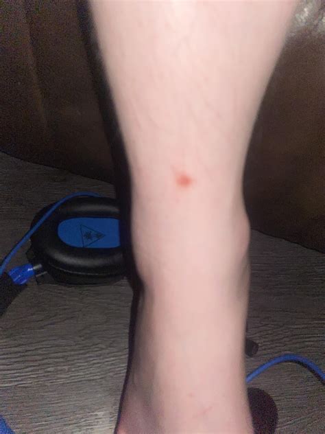 Red Bump On Leg Wont Go Away Rskincareaddicts