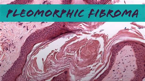Pleomorphic Fibroma Looks Like Skin Tag But Relative Of Spindle Cellpleomorphic Lipoma