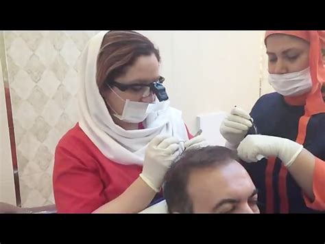 کاشت مو بدون کوتاه کردن موی سر