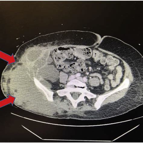 Large Indurated Mass On The Right Hipflank Spontaneously Draining