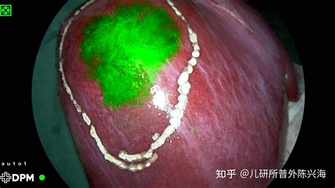 手术中的高德地图——应用肿瘤荧光显像技术进行肝母细胞瘤术中的精准导航 知乎