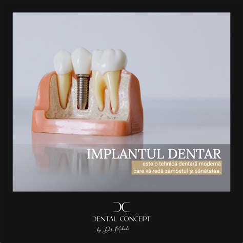 Cât durează un implant dentar Etapele și pașii unui implant dentar Dental Concept