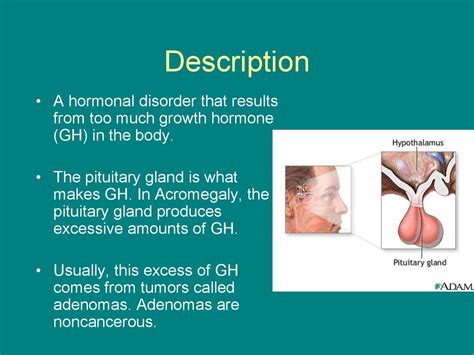 Acromegaly Description презентация онлайн