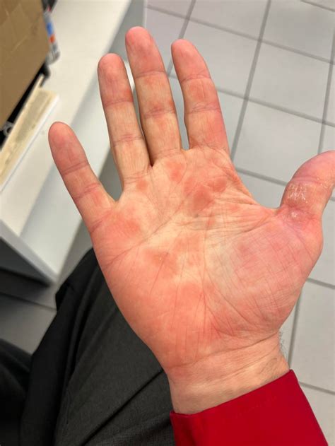 Help Identifying See Comment For Info R Scleroderma