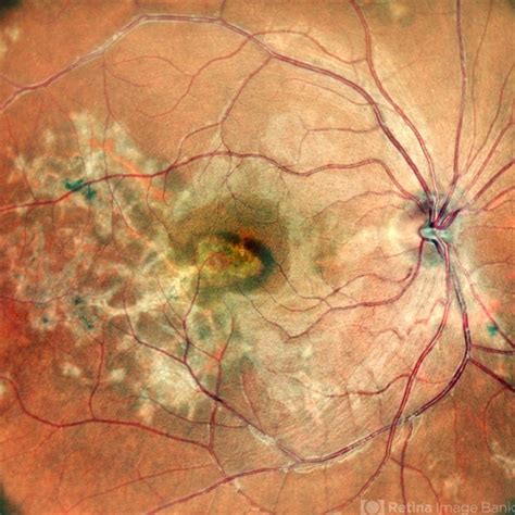 Healed Multifocal Choroiditis Retina Image Bank