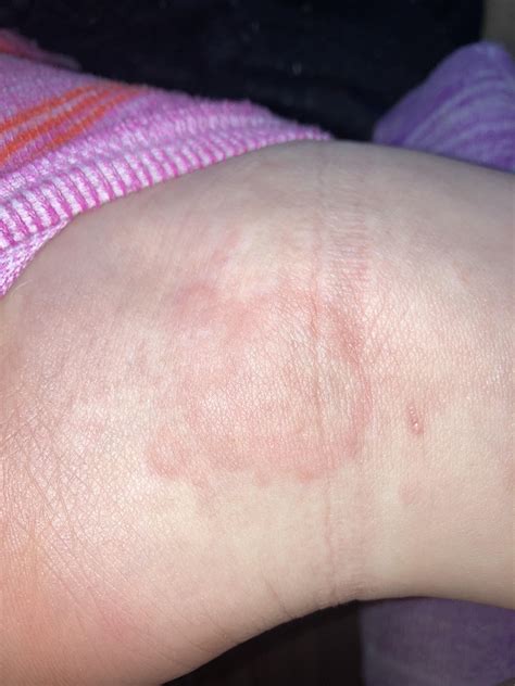 Rash On Ankle Raskdocs