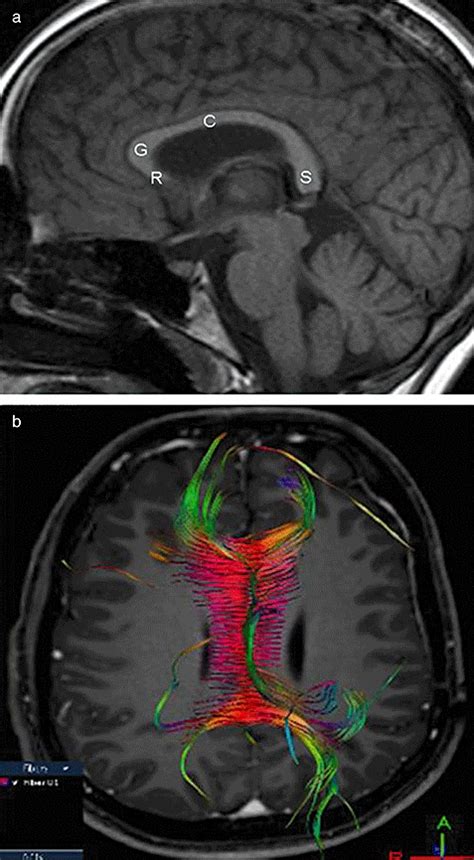 Normal Appearance Of The Corpus Callosum CC In 6 Year Old Boy