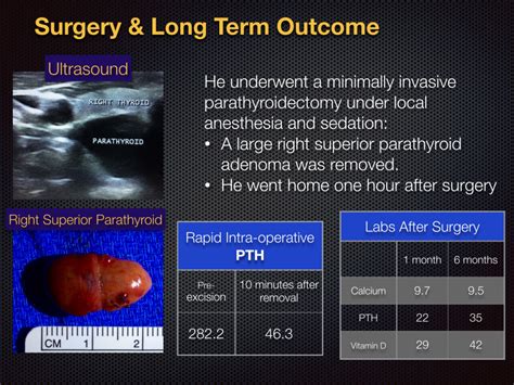 Img0810 Hyperparathyroidism Surgery Dr Babak Larian