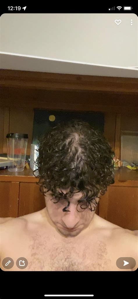 Te Diagnosis R Telogeneffluvium