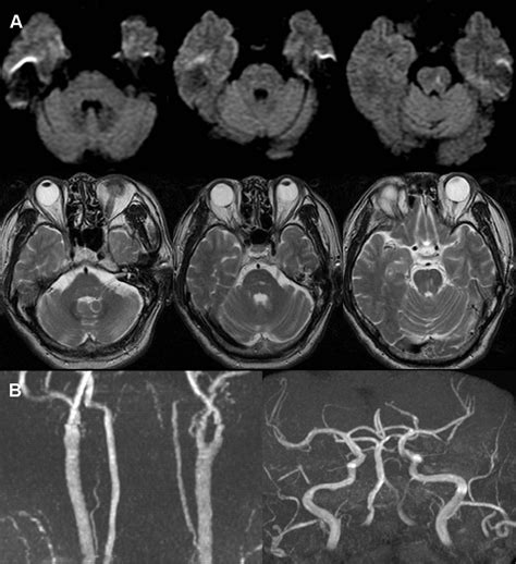 Brain Mri And Mra 4 Days After Symptom Onset A Diffusion And