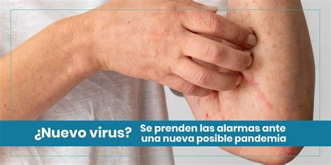 Viruela Del Mono Y Su Impacto En La Sociedad