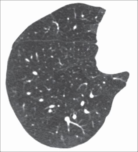 Diagnosing Interstitial Lung Disease Arrs Inpractice