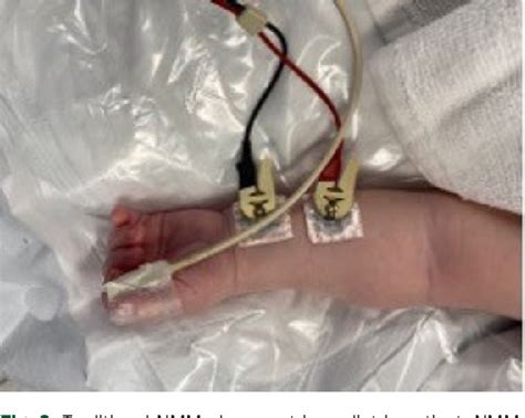 Figure 3 From Neuromuscular Blockade Monitoring In Pediatric Patients Semantic Scholar