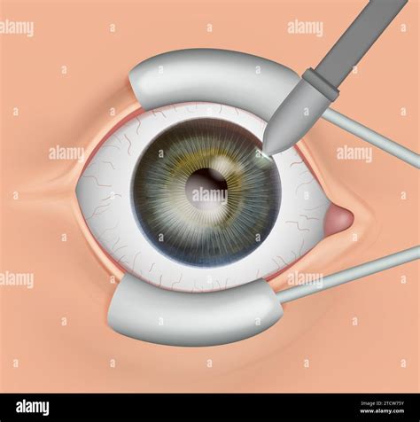 The Procedure Of Eye Surgery Anatomy Of The Eye Stock Vector Image