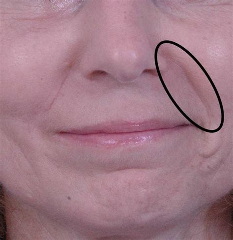 Nasolabial Folds Causes Treatment Exercises And Prevention