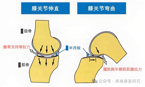 正常半月板损伤 VS 盘状半月板损伤 MedSci cn