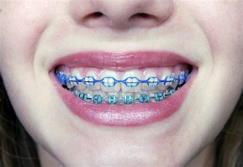 Pretty Smile With Braces Stock Image Image Of Girl Young 5886225