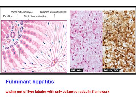 The Liver And Gallbladder Pathology Ppt