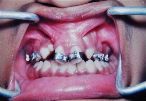 Postoperative Showing Erruption Of Tooth Download Scientific Diagram