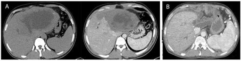 Axial Non Contrast And Contrast Enhanced Computed Tomography Ct