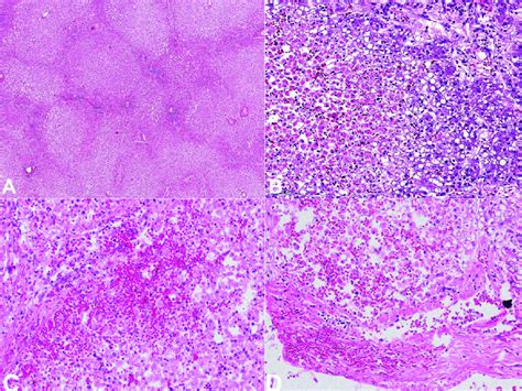 Photomicrographs Of A Liver The Areas Of Centrilobular Necrosis And